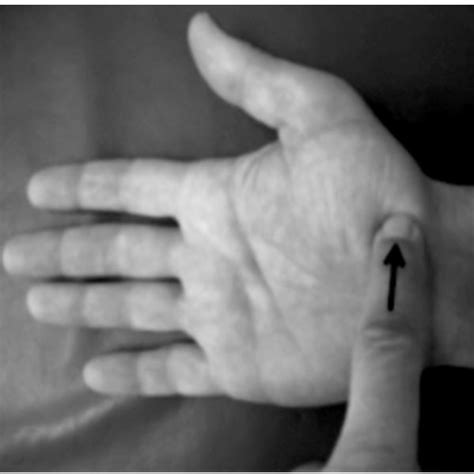 The Three Classic Clinical Tests For Scaphoid Fracture A Anatomical