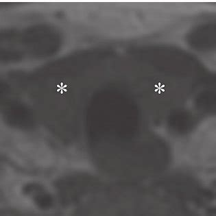 Colloid Nodule Transverse US Image Shows A Predominantly Anechoic Download Scientific Diagram