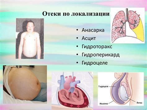 Отеки