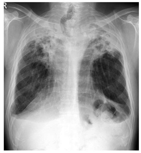비활동성 폐결핵 폐엑스레이 증례 흉막비후 공동 공기낭종 네이버 블로그