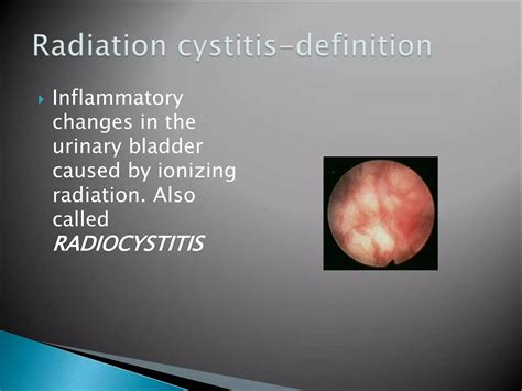 Radiation Cystitis Ppt At May Myers Blog