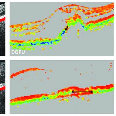 Polarization Sensitive Optical Coherence Tomography Ps Oct A Download Scientific Diagram