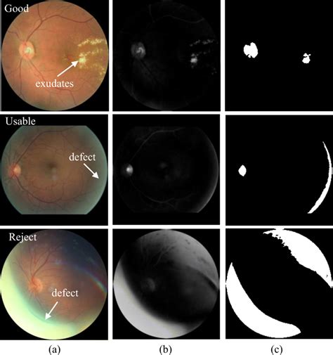 Examples For Detecting Large Size Salient Structures From Retinal