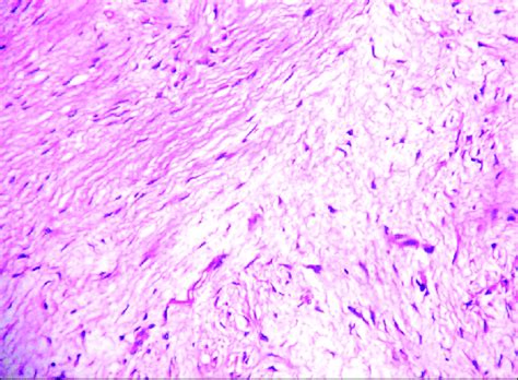 Exceedingly Myxoid Stroma Hematoxylin And Eosin ×40 Download Scientific Diagram