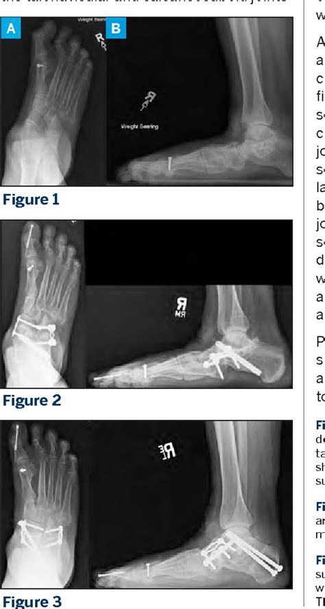 Figure 2 From Revision Of Failed Triple Arthrodesis For Flatfoot