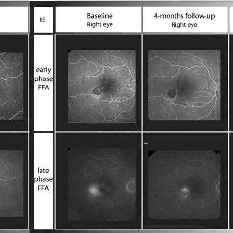 OCT Findings Macular Map And Horizontal Macular Scan Of The Right Eye Download Scientific
