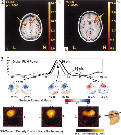Figure 2 From Non Invasive Epileptic Focus Localization Using Eeg Triggered Functional Mri And
