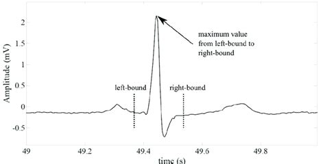 qrs complex peak determination download scientific diagram