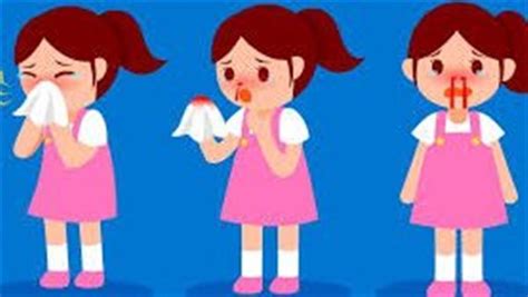 تعرف على أعراض نزيف الأنف عند الأطفال وكيفية التعامل معه