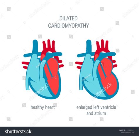 231 Imágenes De Dilated Cardiomyopathy Imágenes Fotos Y Vectores De