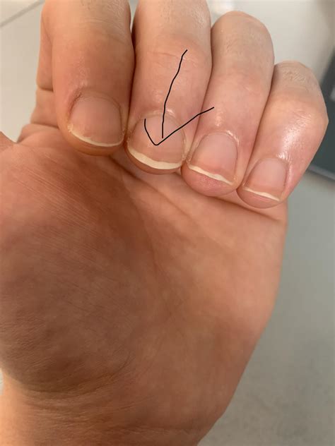 Onychodermal Band Anatomy Bony Pelvis And Lower Limb Toe Nails