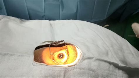 Suprachoroidal Injection Youtube