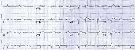An Unusual Case Of Chest Pain AAFP