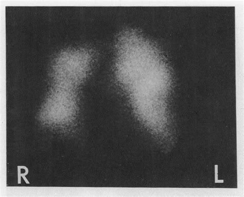 Lung Scintigram In Case 2 Showing Multiple Per Fwion Defects In Both Download Scientific