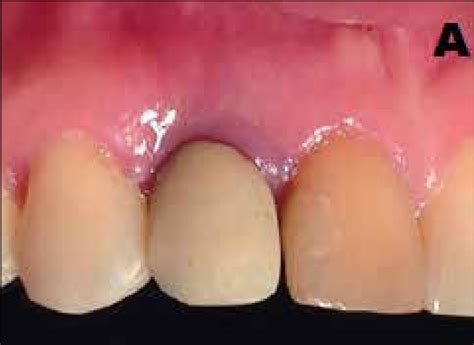 A Preoperative View Of Tooth FDI Tooth Numbering System Download Scientific Diagram