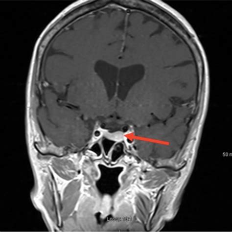 Thyroid Uptake Scan Thyroid Uptake Scan Technetium M Download Scientific Diagram