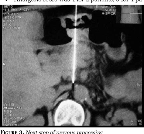 Figure 3 From Celiac Plexus Block With Control Of Computerized Tomography Semantic Scholar