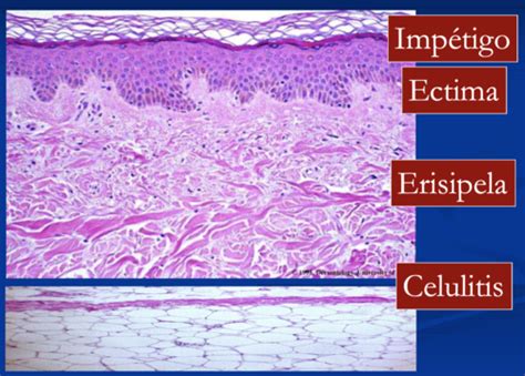 Infecciones Bacterianas Cutáneas Quizlet