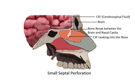 Nasal Septal Perforation Surgery Norelle Health