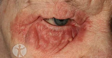 Blepharitis Associated With Seborrhoeic Dermatitis Image
