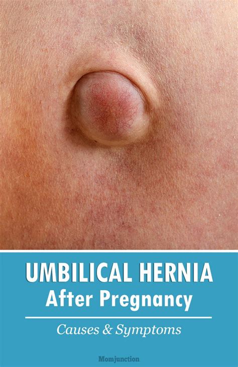 Purple Herniated Belly Button At Jake Burdekin Blog