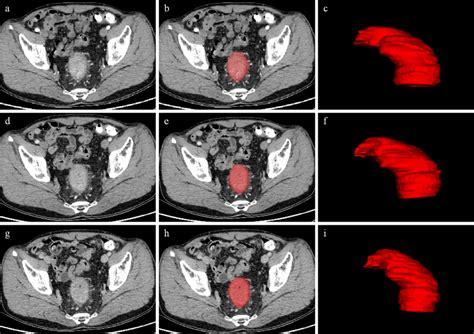 A 58 Year Old Female With Rectal Cancer Was Pathologically Conrmed To Download Scientific