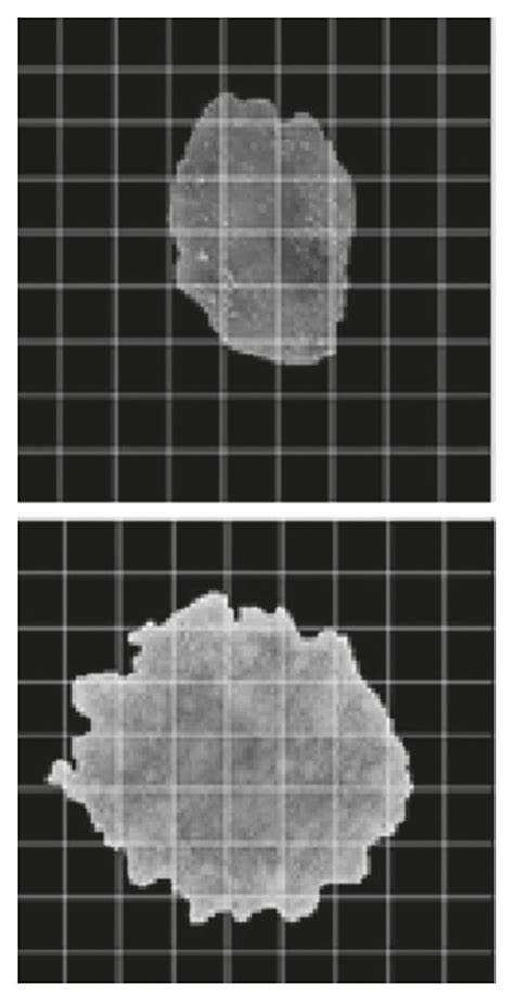 Activation Map For Resnet For An Example Of Melanoma First Row And