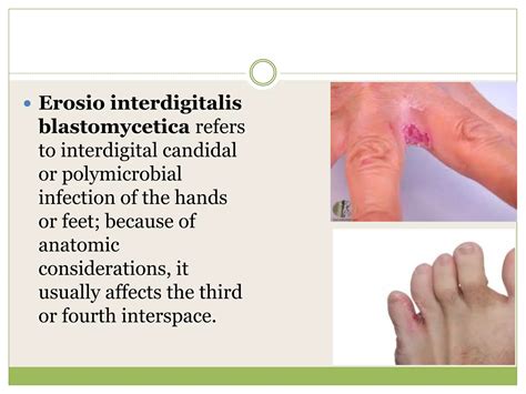 Candidiasis Pptx