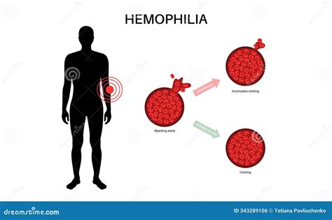 Hemophilia Inheritance Poster Cartoon Vector 343526785
