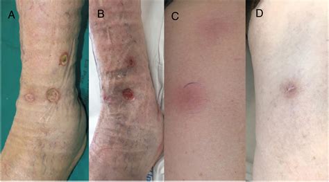 Eritema Indurado Vasculitis Nodular