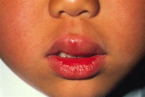 Home Remedies To Get Rid Of Swollen Lips Artofit