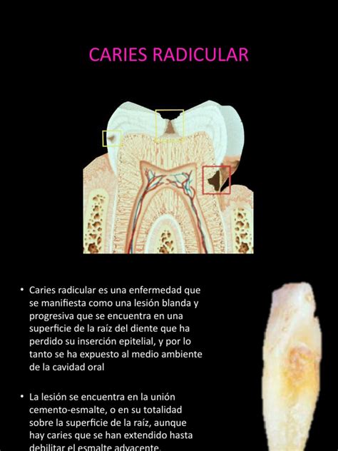 Caries Radicular Apunte Unap Pdf Esmalte De Dientes