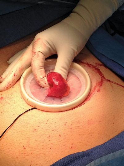 Right Hemicolectomy And Ileocecectomy Single Port Laparoscopic