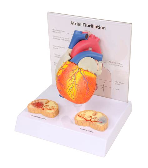 Atrial Fibrillation Model BSI Catalog
