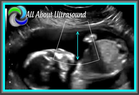 Leaking Amniotic Fluid Look Like Unareplans Leaking Amniotic Fluid Look Like Unareplans