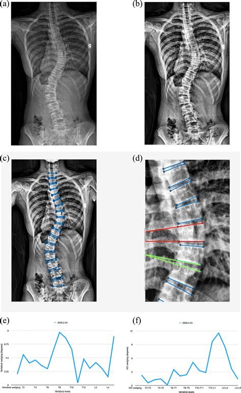 Steps In The Measurement Process A Original X Ray B After The X Ray