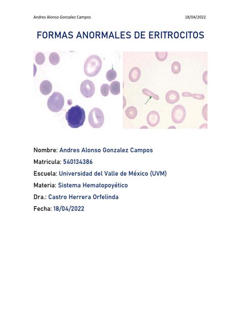 Formas Anormales De Eritrocitos Pdf Glóbulo Rojo Anemia