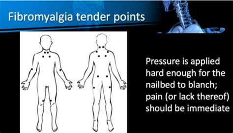 Fibromyalgia Flashcards Quizlet