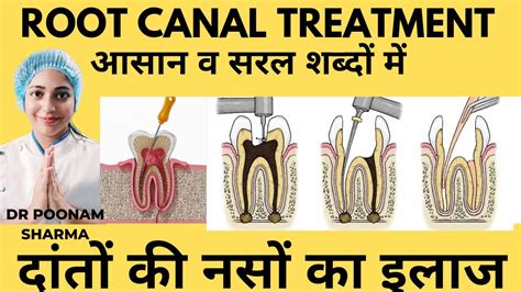 Root Canal Treatment आसान और सरल भाषा में Root Canal Treatment