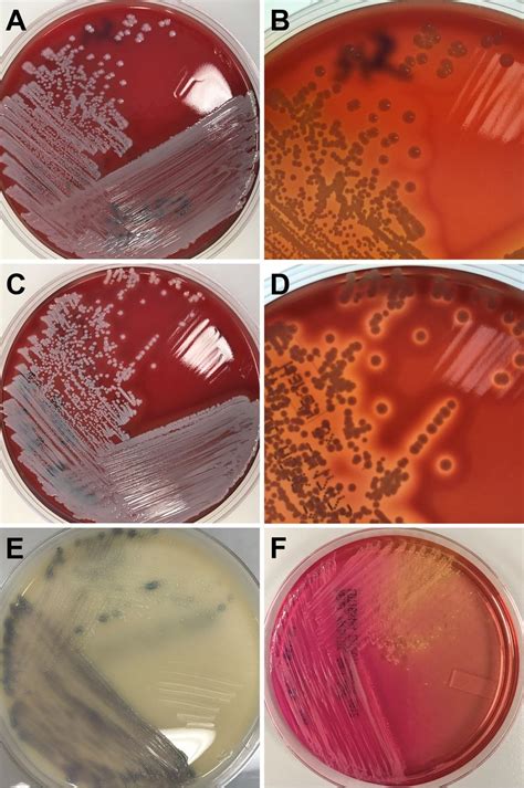 Beta Hemolysis Staphylococcus Aureus