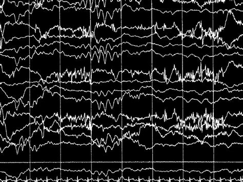 Eeg In Neonates Normal Variants And Pathological Traces Ppt Eeg In Neonates Normal Variants And Pathological Traces Ppt