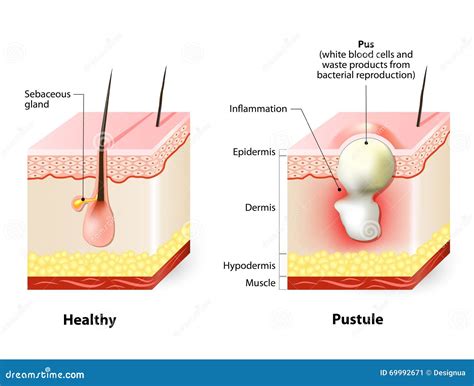 Healthy Skin And Pustules Stock Vector Illustration Of Dermis