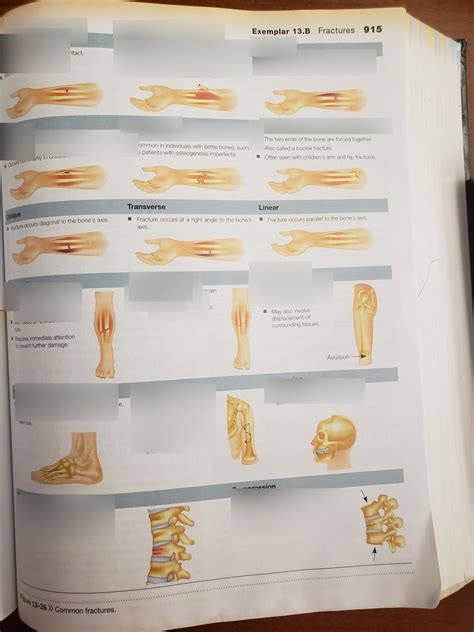 Fractures Diagram Quizlet