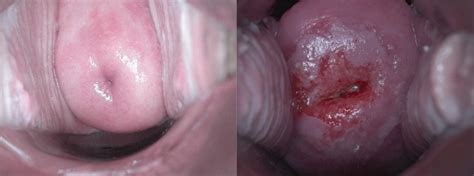 Edukasi Pasien Pemeriksaan Inspeksi Visual Asetat Iva Alomedika