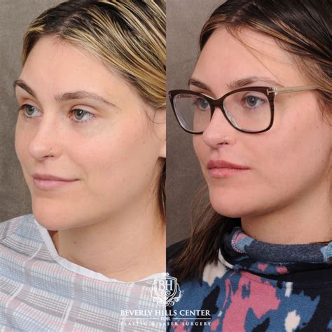 Chin Reduction Surgery Protruding Chin Reduction Clinic Search Korea