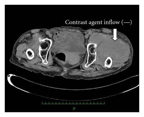 Contrast Enhanced Ct Scan At 2 Months After The Embolization