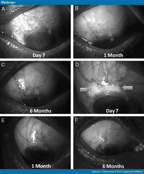 Bevacizumab Vs Mitomycin C In Phacotrabeculectomy Page 3