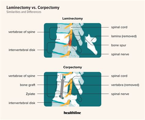 Corpectomy Vs Laminectomy How They Are Different