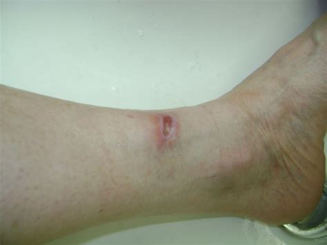 What Is A Pseudomonas Aeruginosa Infection Like HealDove