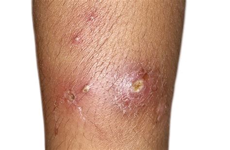 Hair Follicle Infection Symptoms Prevention And Treatment